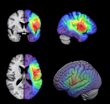 Artificial Intelligence-Driven Imaging Tool for Assessing Strokes Is ...
