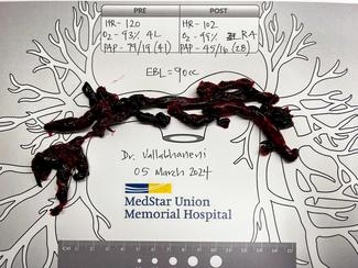 MedStar Health, the Region's Leader in Catheter-Based Pulmonary ...