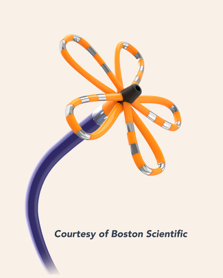 Pulsed Field Ablation Treatment | MedStar Health