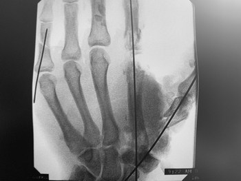 MedStar Health Prepares for Fireworks Season with Safety Tips and Warning