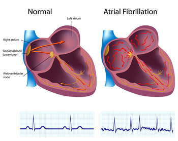 How Does Obesity Impact the Heart? | MedStar Health