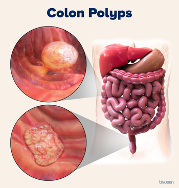 Colon Polyps | Symptoms & Treatments | Medstar Health