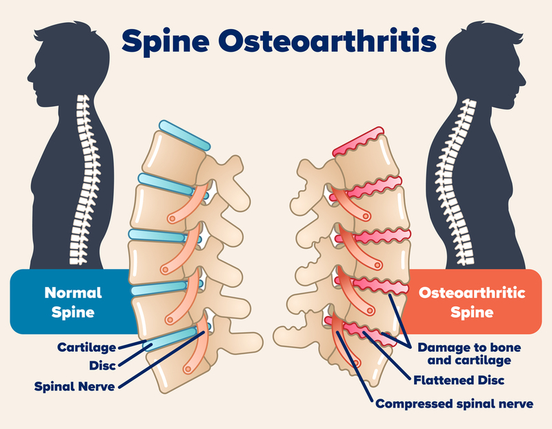 Degenerative Joint Disease Causes Treatment Arthralgia. Causes,